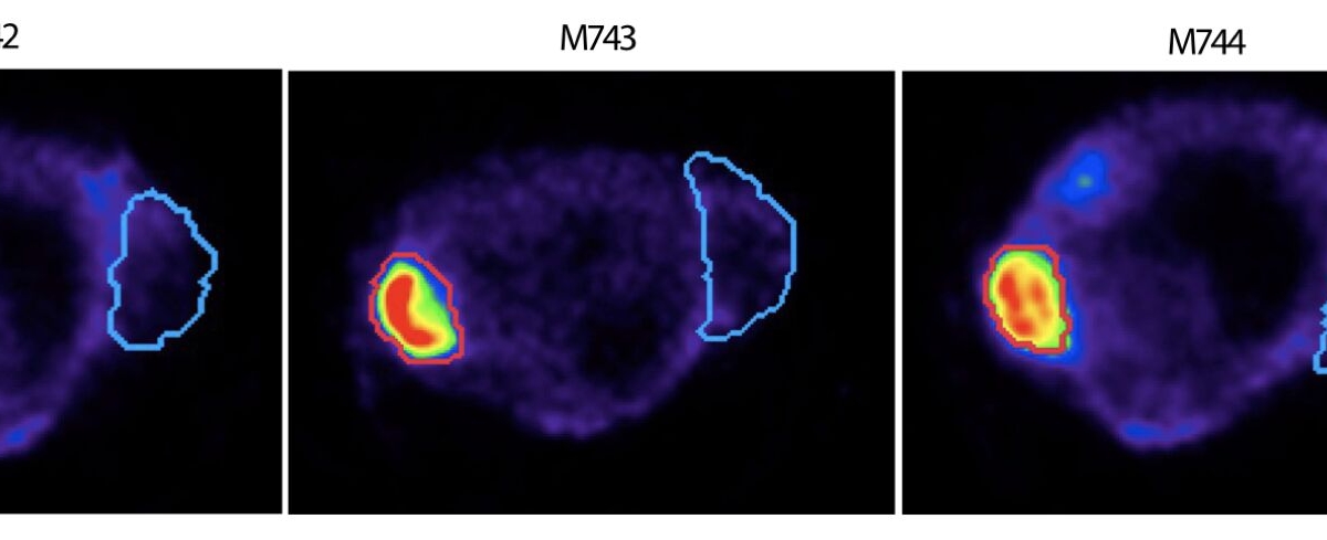 Monitoring Therapeutic Response to Anti-Fibroblast Activation Protein ...